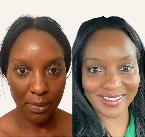 Eyelids Droopy After Botox: Unveiling the Mystery Behind Ptosis ...